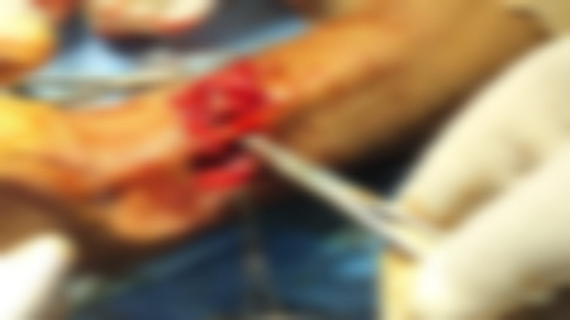 First-Ever Tendon Repair Procedure Successfully Performed at Sub ...